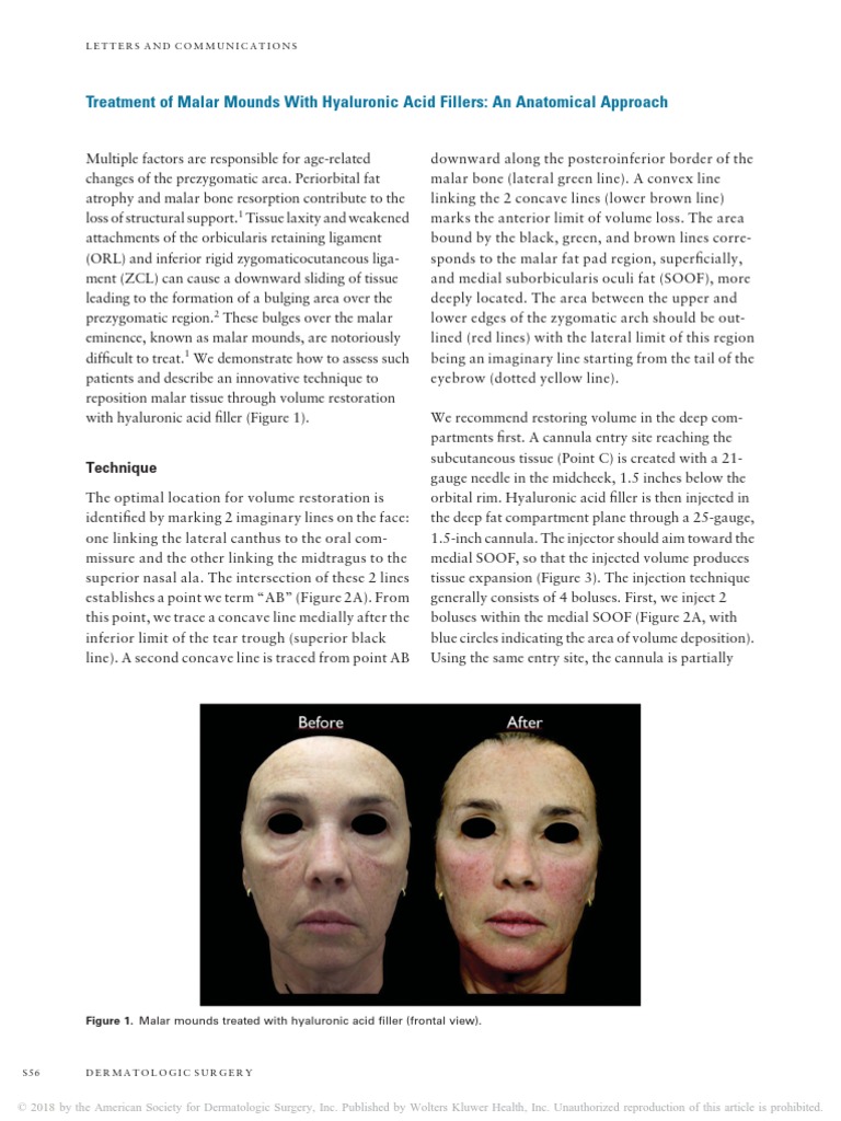 Treatment of Malar Mounds With Hyaluronic Acid Fillers - An Anatomical ...