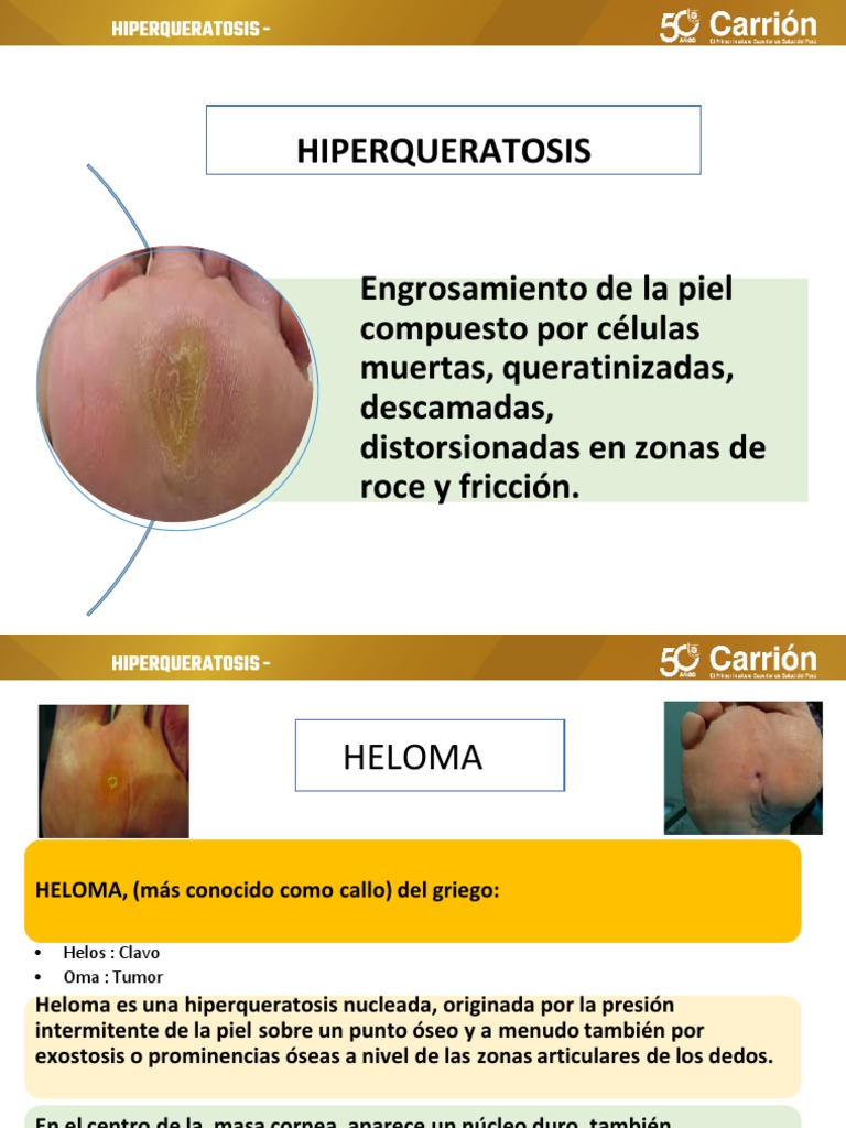 Tipos y Tratamientos de Helomas | PDF | Dermatología | Medicina CLINICA