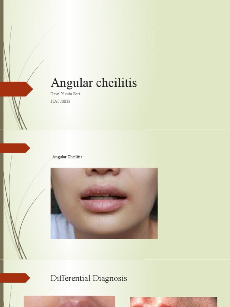 Angular Cheilitis | PDF