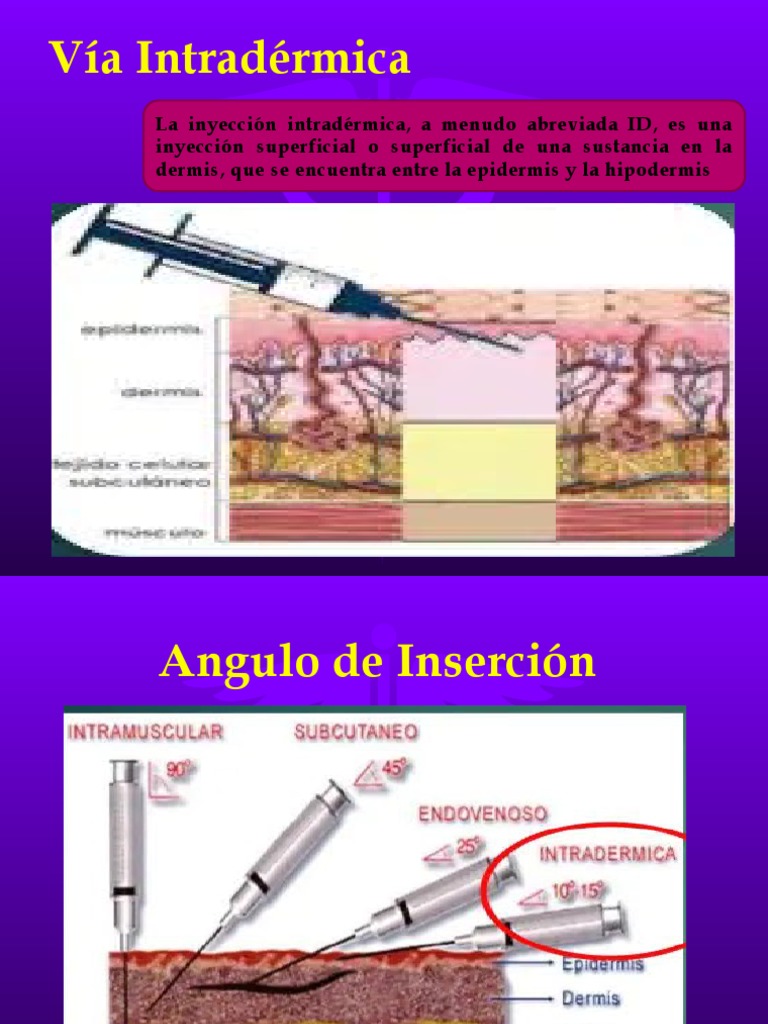 Inyección intradérmica: descripción del procedimiento, sitios de ...