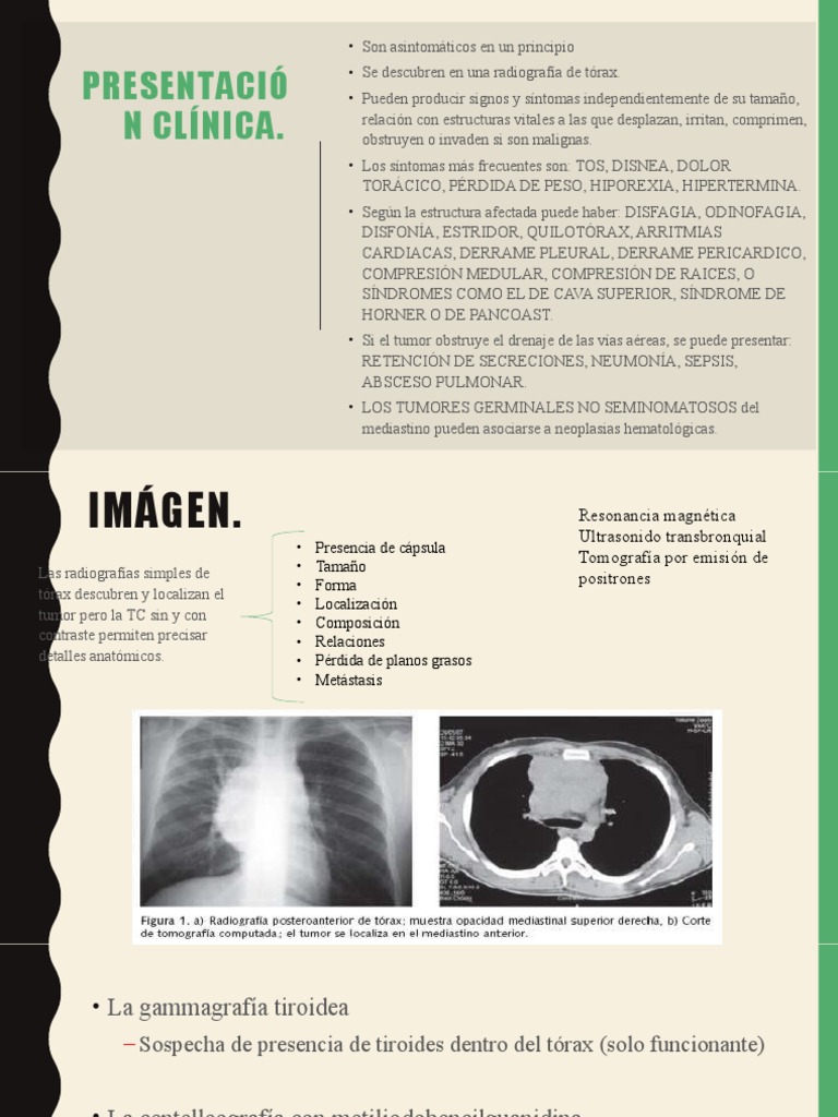 Tumores Del Mediastino, Completo | PDF | Neoplasias | Medicina