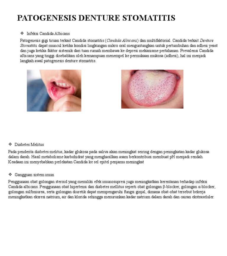 Patogenesis Denture Stomatitis | PDF | Kesehatan Holistik