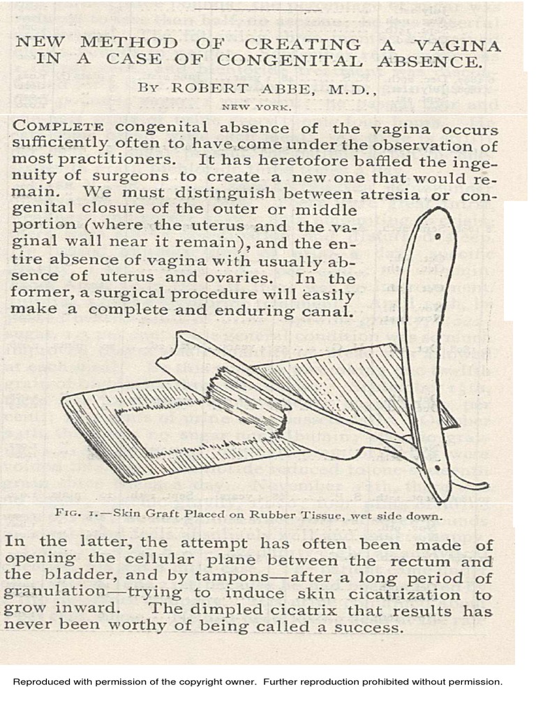 1898-New Method of Creating A Vagina in Case of Congenital Absence | PDF
