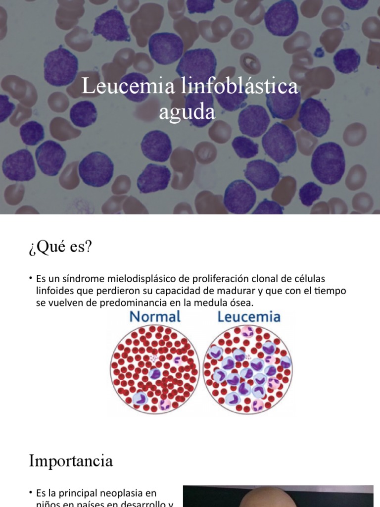 Leucemia linfoblástica aguda | PDF | Leucemia | Medicina CLINICA