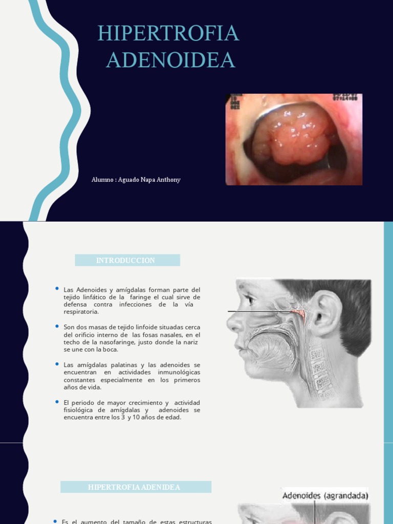 Hipertrodia Adenoidea | PDF | Especialidades Medicas | Medicina CLINICA