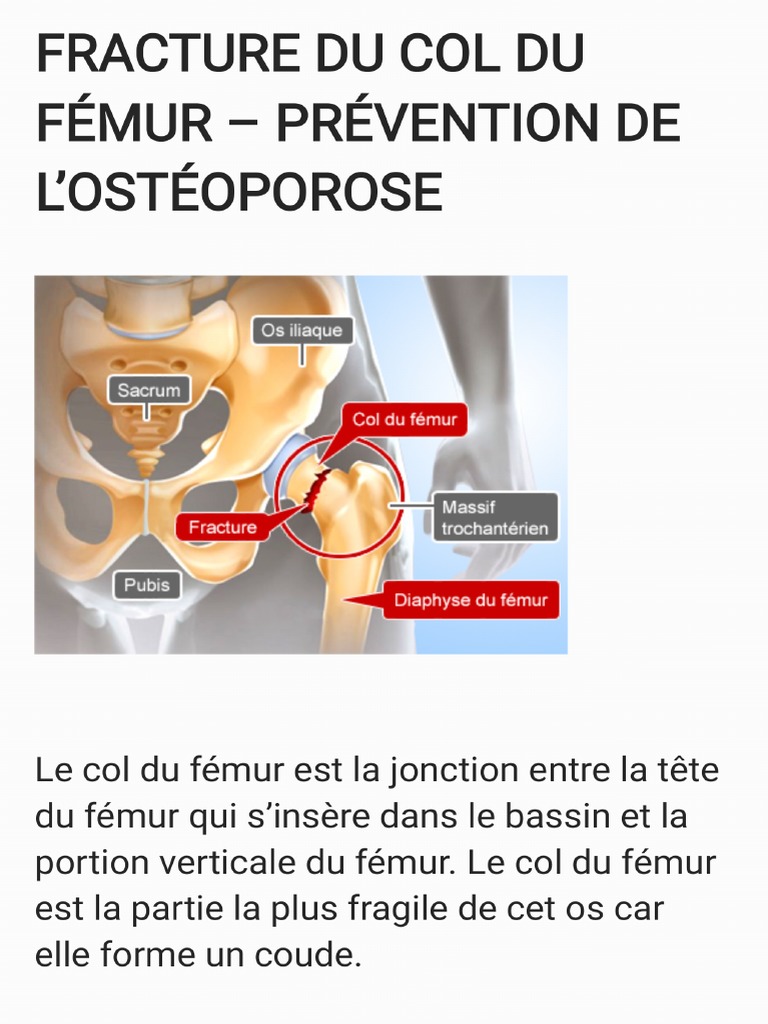 Fractures Du Col Fémoral | PDF