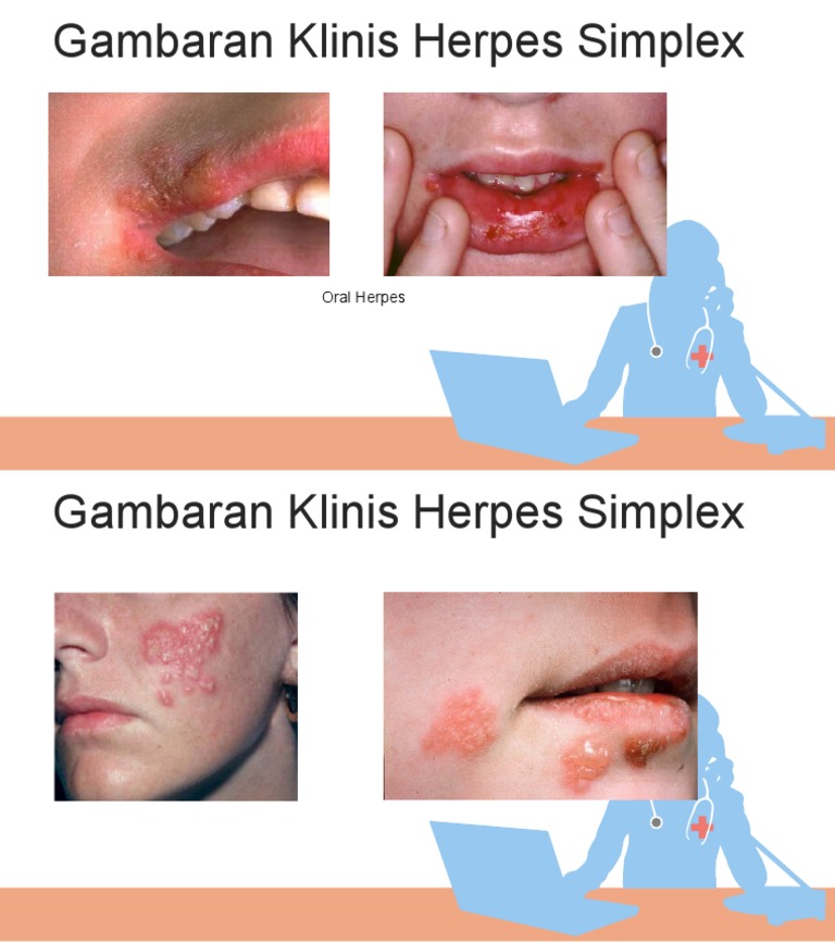 Herpes Simpleks | PDF