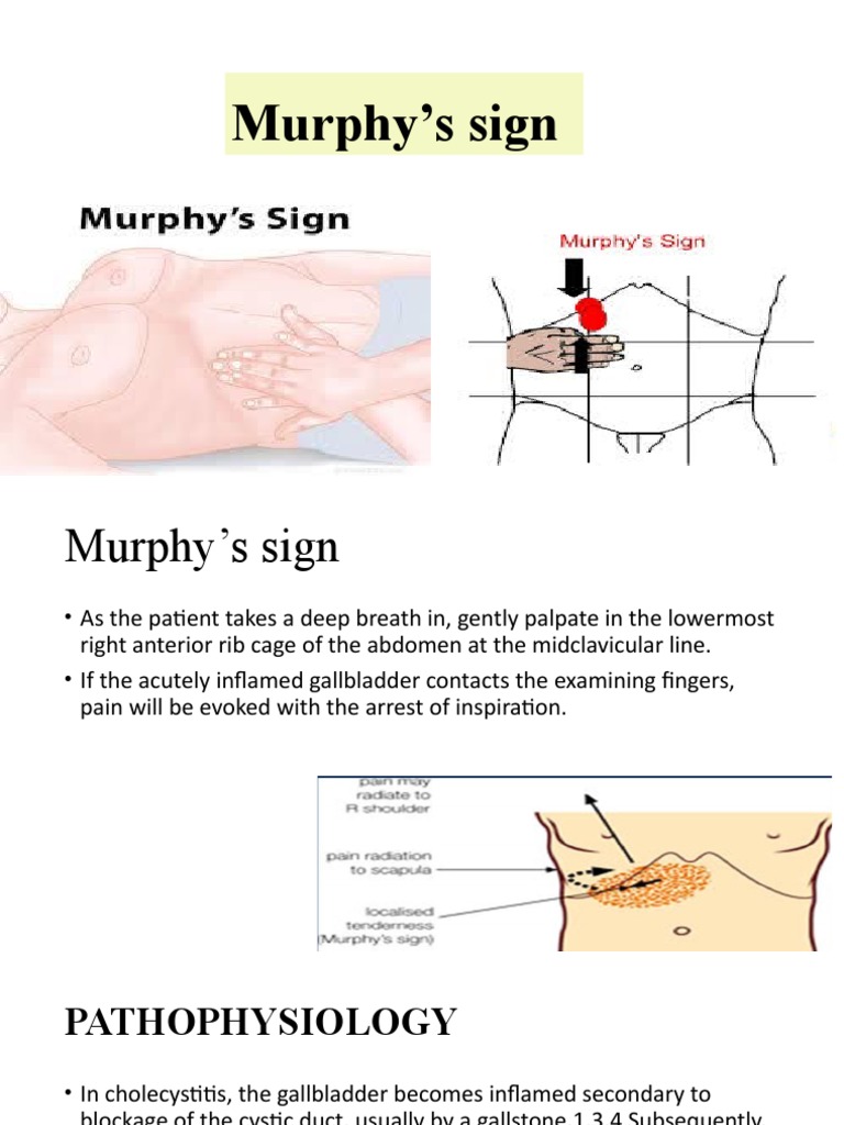 Murphy's Sign | PDF