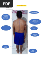 Test de Adams | PDF | Escoliosis | Especialidades Medicas