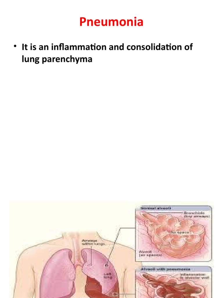 Pneumonia IMCI | PDF | Pneumonia | Lung