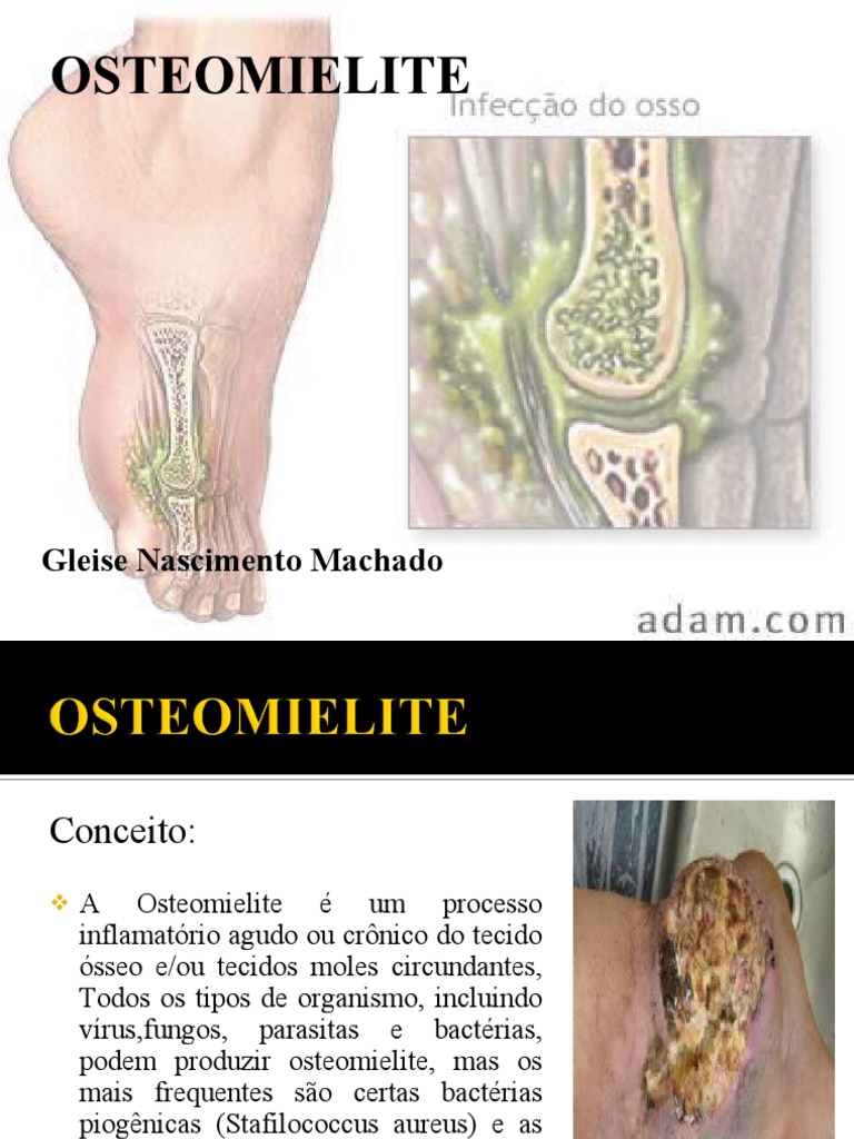 OSTEOMIELITE Slides | PDF | Câncer | Especialidades médicas
