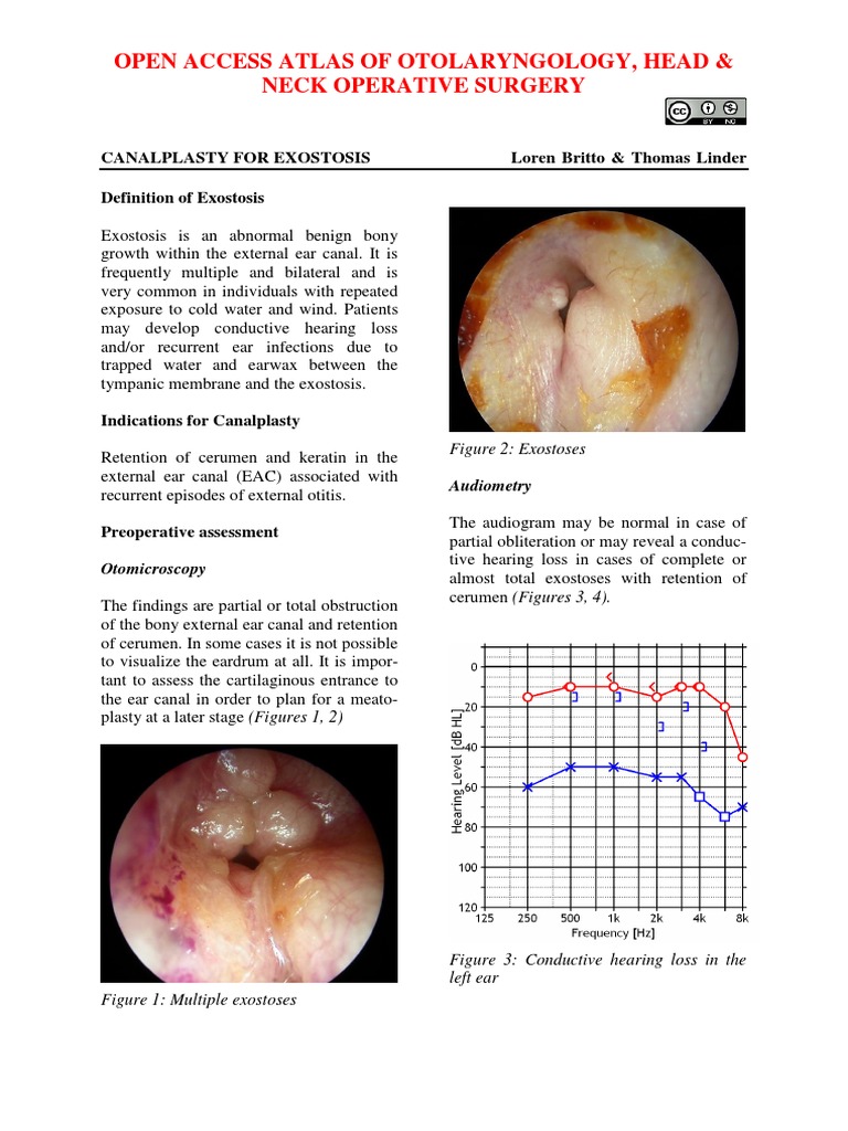 Canalplasty For Exostosis | PDF | Ear | Surgery