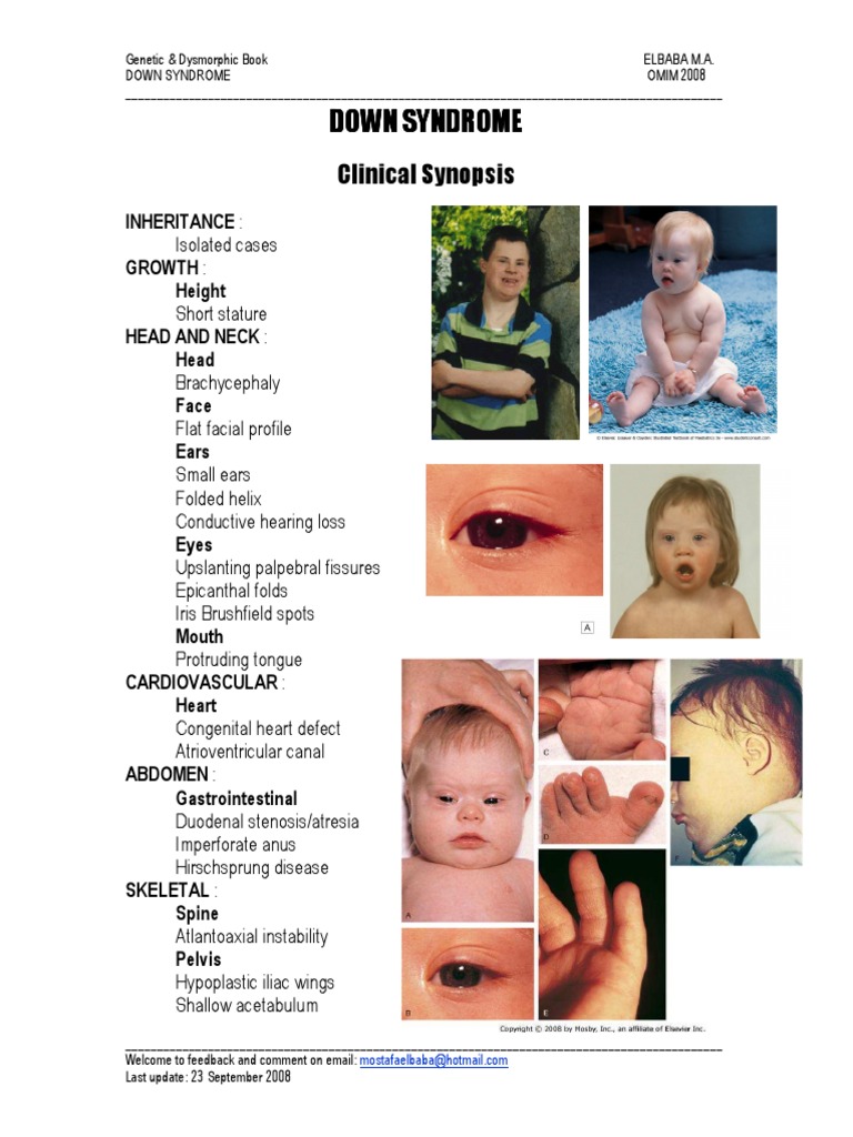 Down Syndrome | PDF | Down Syndrome | Diseases And Disorders