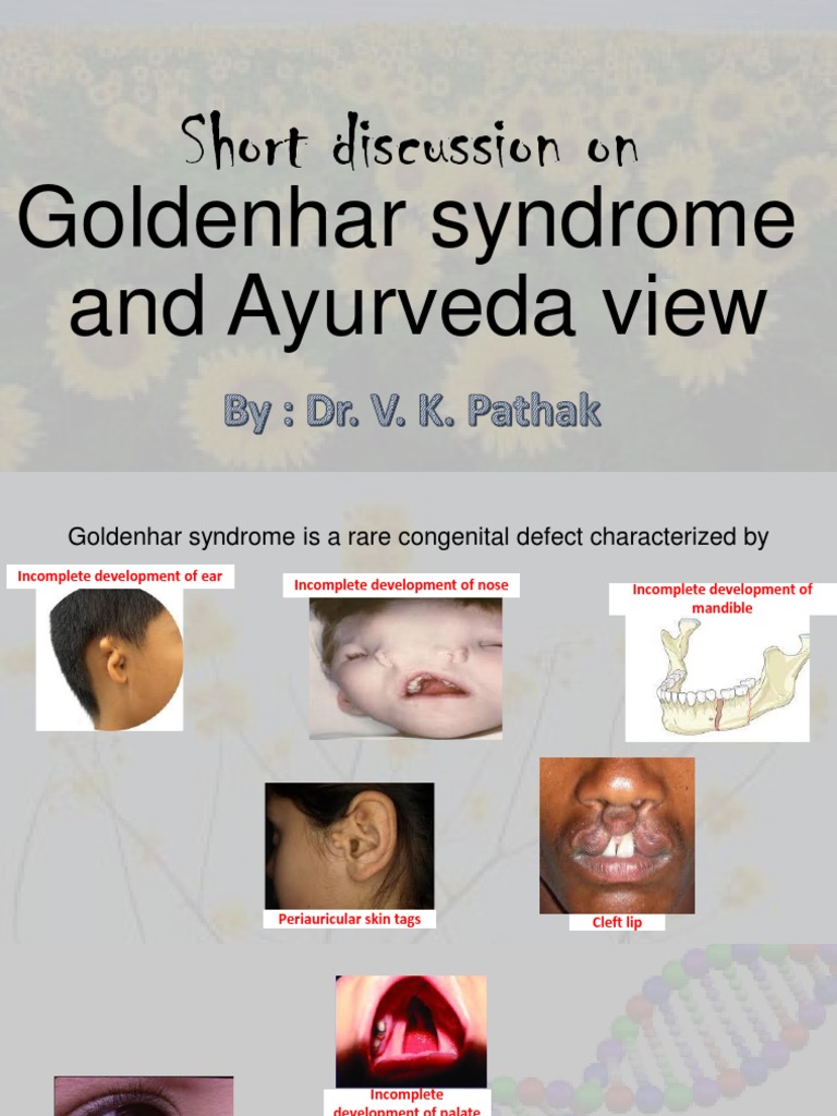 Goldenhar Syndrome | PDF