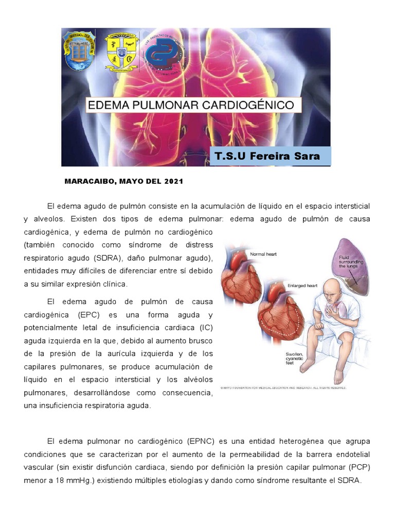 Edema Pulmonar Cardiogenico | PDF | Edema | Insuficiencia cardíaca