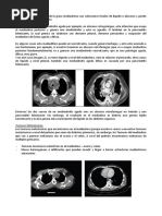 Bullas y Cavernas en Lesiones Pulmonares | PDF | Pulmón | Ct Scan