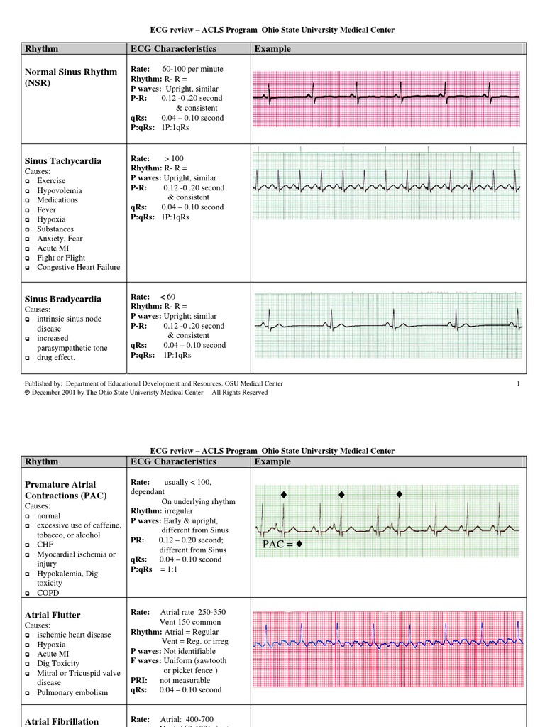 Rhythm ECG Characteristics Example Normal Sinus Rhythm (NSR)