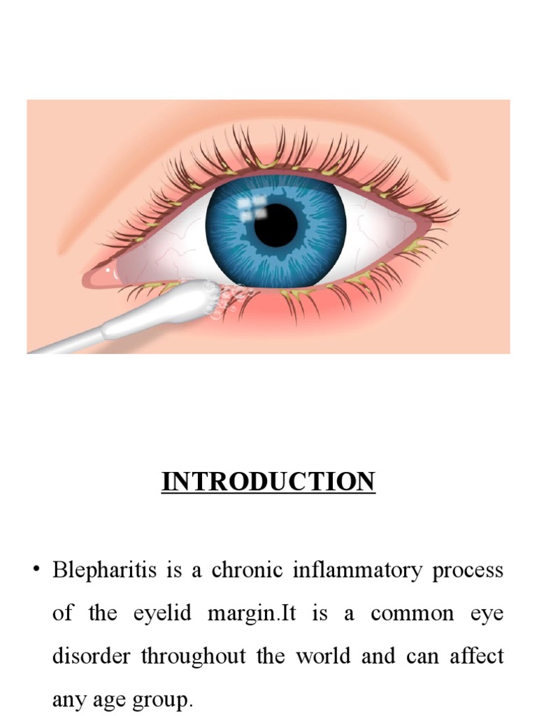 BLEPHARITIS | PDF | Medical Specialties | Human Eye