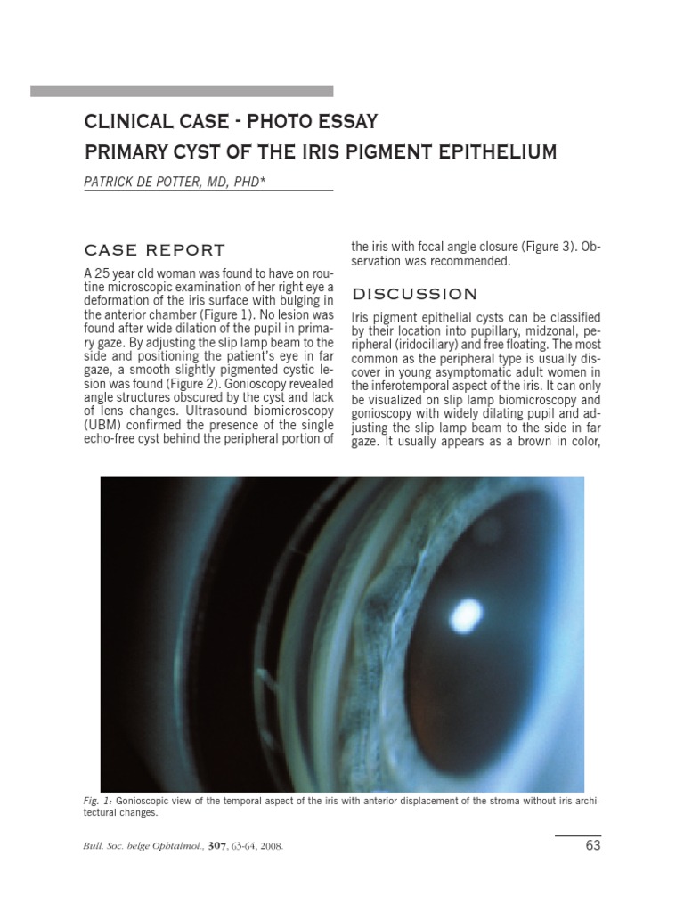 Clinical Case - Photo Essay Primary Cyst of The Iris Pigment Epithelium ...
