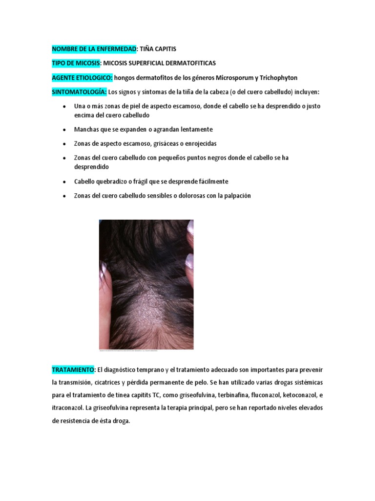 Tiña Capitis: Síntomas y Tratamiento | PDF