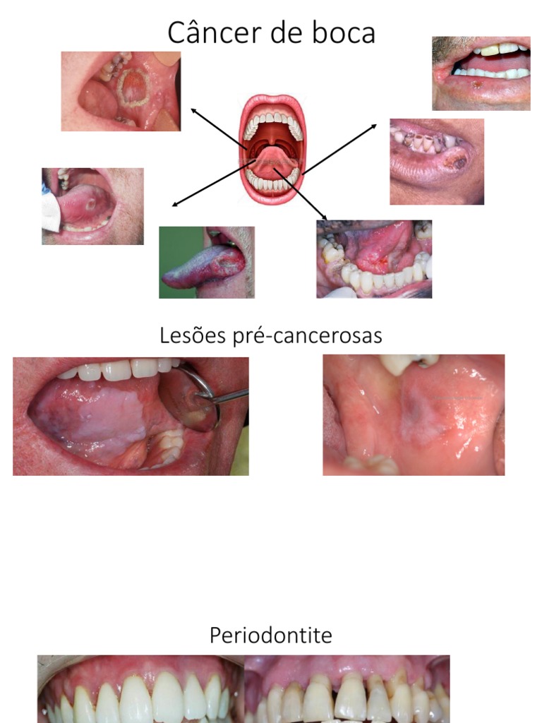 Cancer de Boca Imagens | PDF