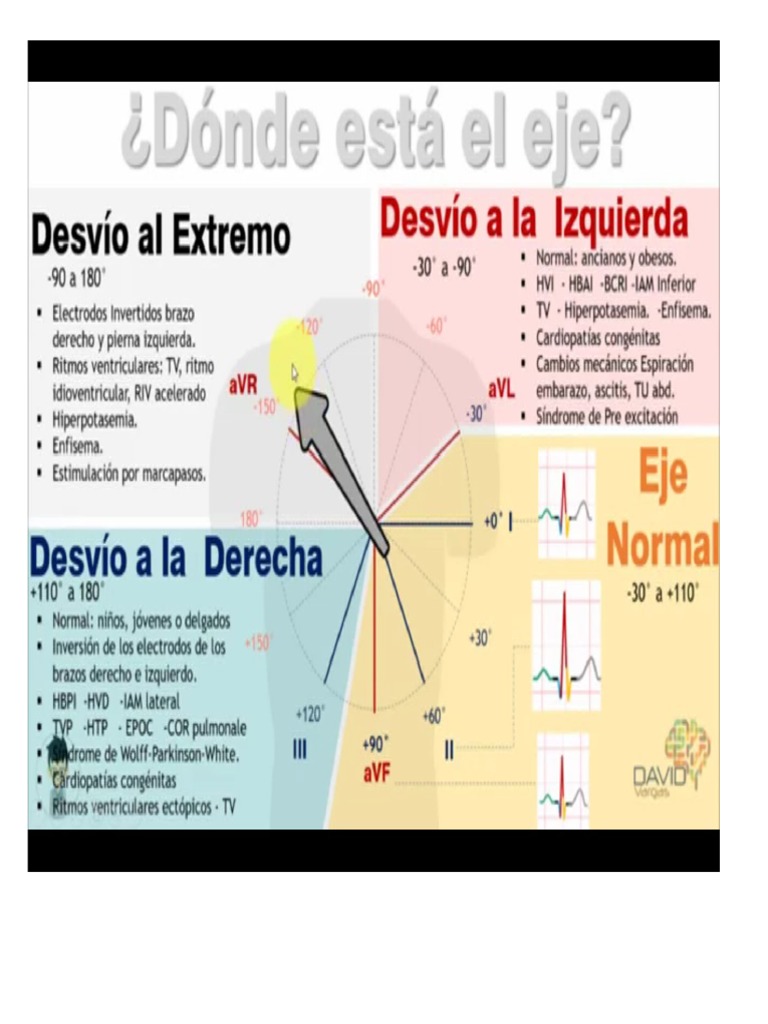 Eje Cardiaco | PDF
