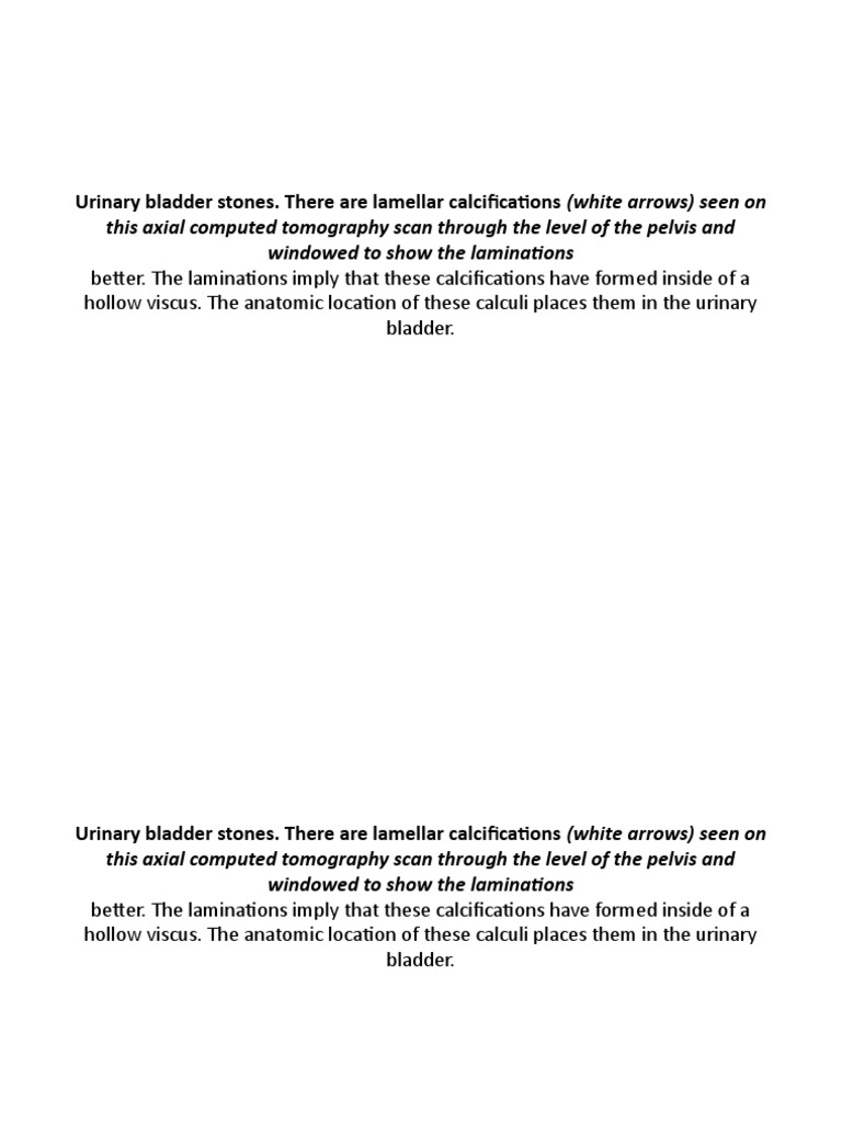 Urinary Bladder Stones. There Are Lamellar Calcifications (White Arrows ...
