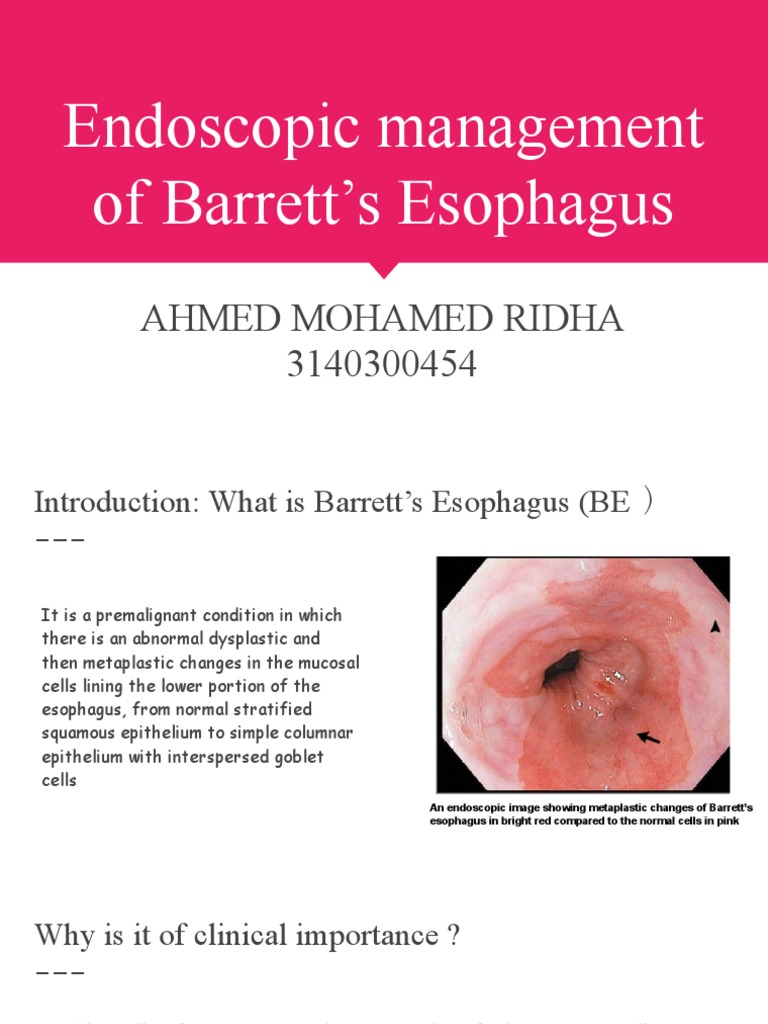 Endoscopic Management of Barrett's Esophagus | PDF | Medicine ...