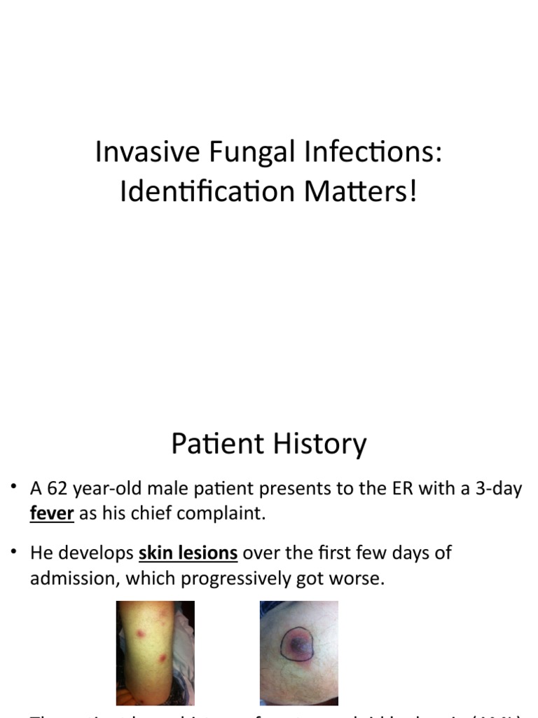 CMMC Case Invasive Fungal Infections Identification Matters Fusarium 3 ...