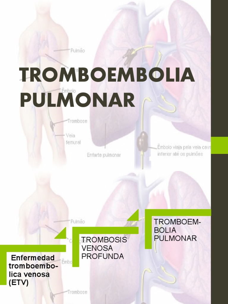 Tromboembolia Pulmonar | PDF | Especialidades Medicas | Medicina CLINICA