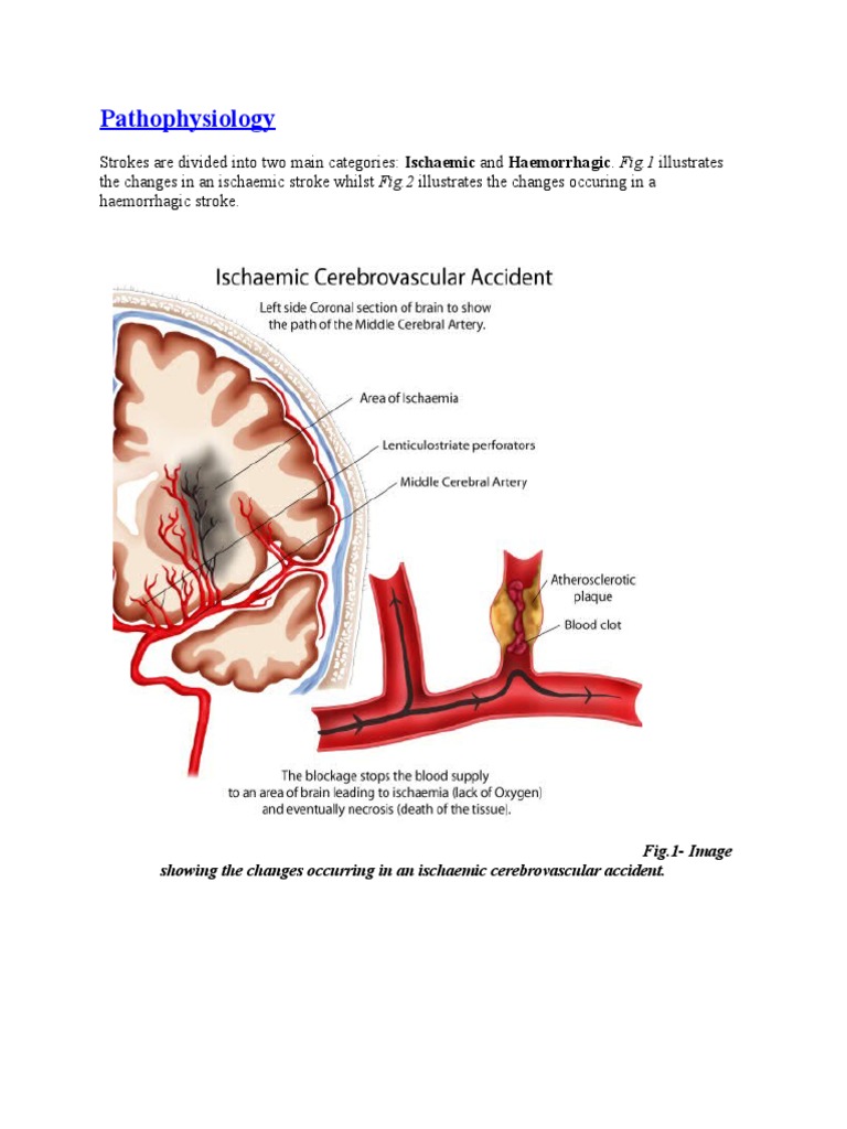 Pathophysiology of Stroke | PDF | Stroke | Ischemia