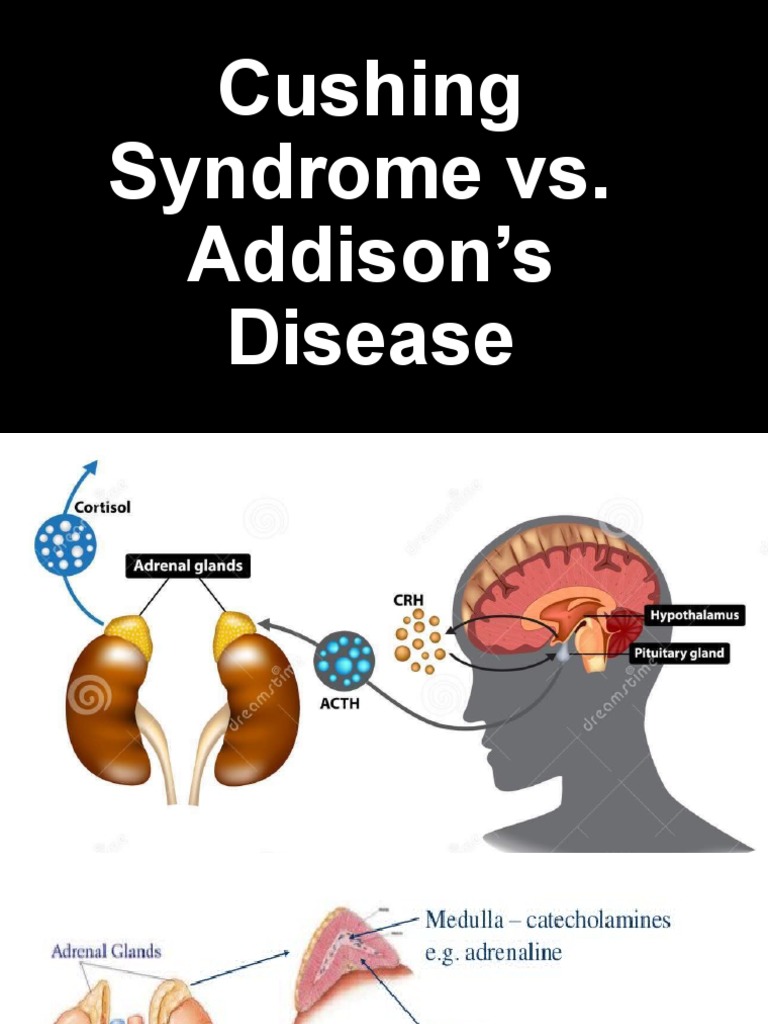NCM 116, Cushing Syndrome, Addison's Disease, Hypo | PDF | Endocrine ...