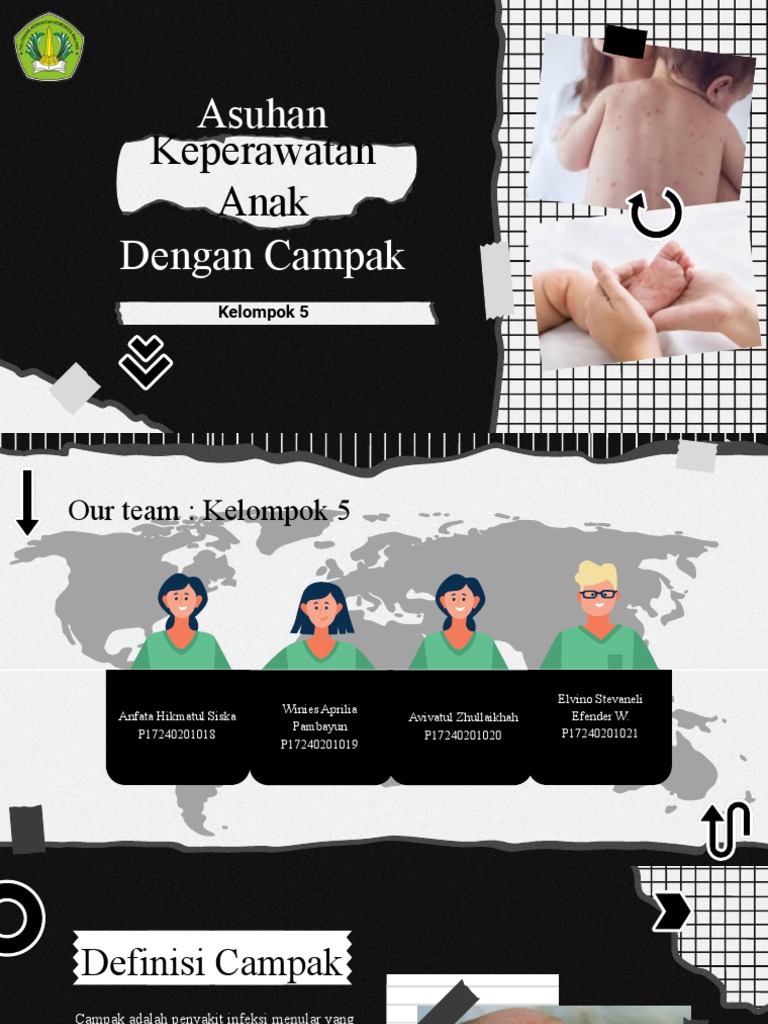 Tugas Kep. Anak - Kel. 5 - PPT Askep Campak Pada Anak - 2a | PDF