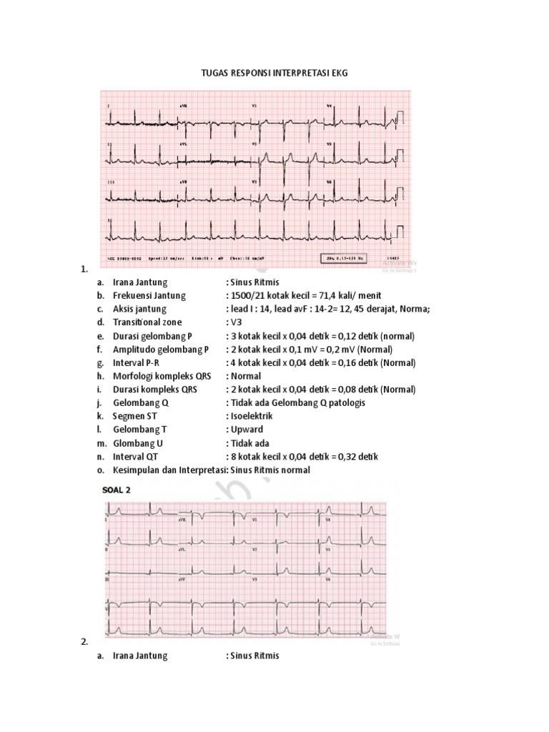 Tugas Responsi Interpretasi Ekg | PDF