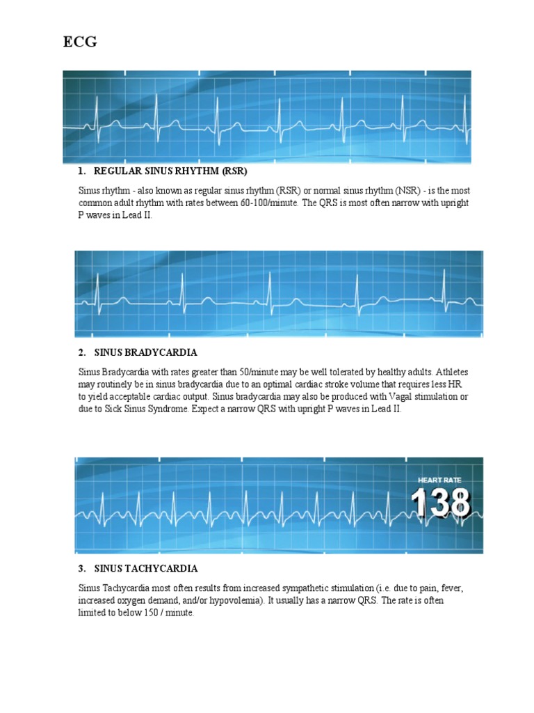 Regular Sinus Rhythm (RSR) | PDF | Electrocardiography | Cardiac Arrhythmia