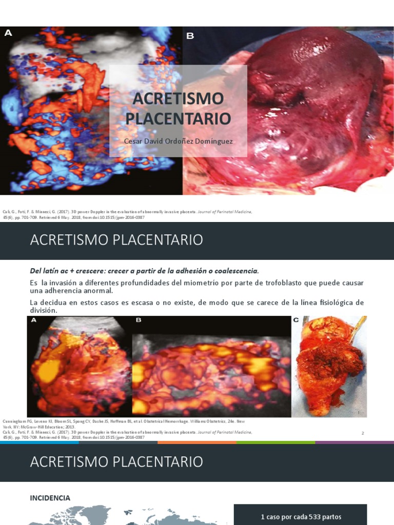 Acretismo 180528213514 | PDF | Placenta | Parto