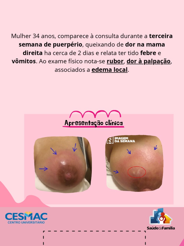 Cópia de Cópia de Afecções Benignas Da Mama | PDF | Saúde pública ...