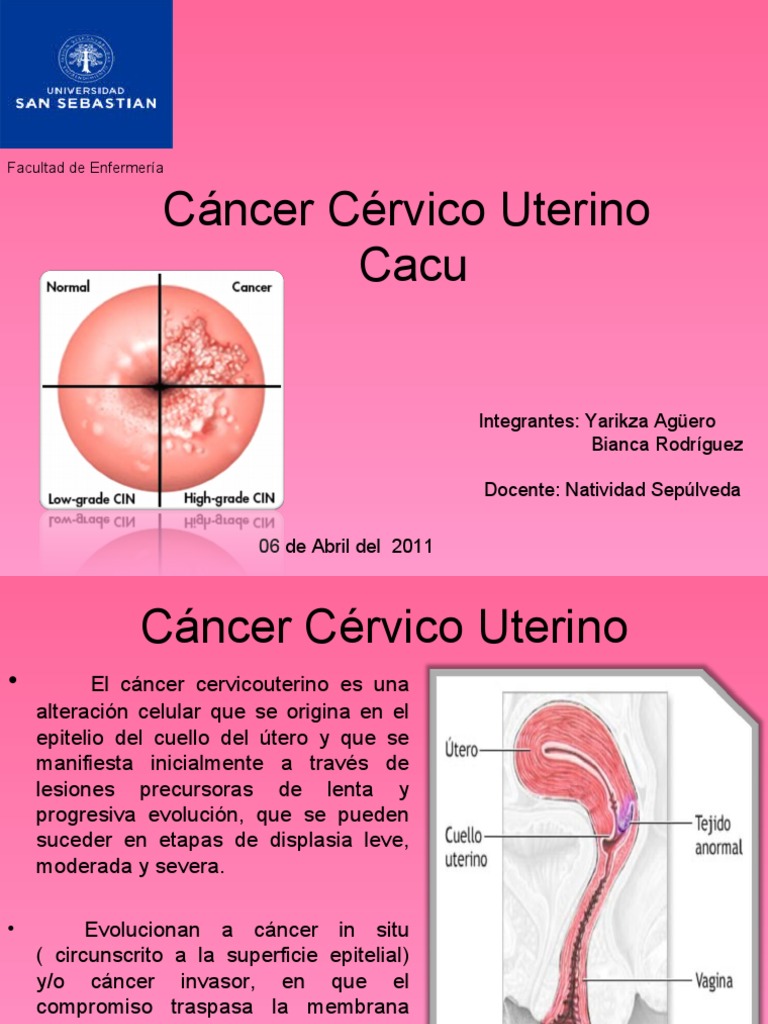 Cáncer Cérvico Uterino | PDF | Cáncer de cuello uterino | Neoplasias