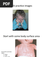 Eczema Area Severity EASI Scoring Tool | PDF | Dermatitis | Dermatology