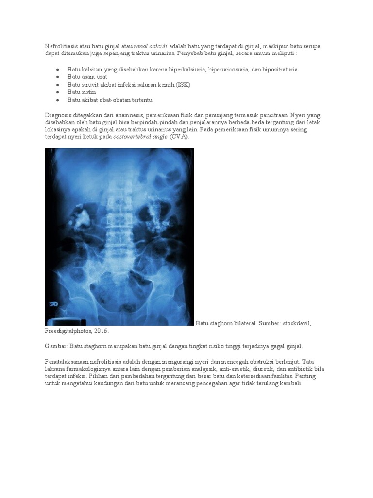 Nefrolitiasis | PDF
