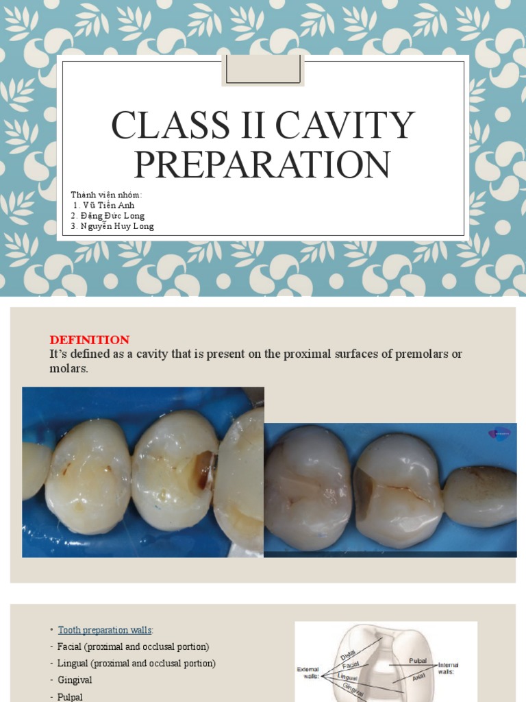 CLASS II Cavity Preparation | PDF | Tooth Enamel | Tooth