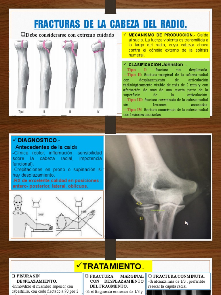 Fracturas de La Cabeza Del Radio | PDF | Mano | Sistema musculoesquelético Fracturas de La Cabeza Del Radio | PDF | Mano | Sistema musculoesquelético