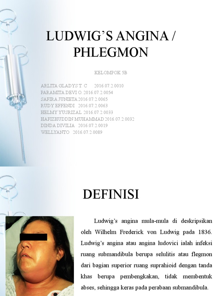Ludwig's Angina | PDF