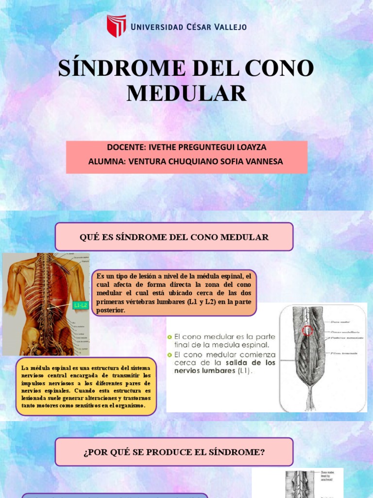 Síndrome Del Cono Medular - Ventura Chuquiano Sofia Vannesa | PDF ...