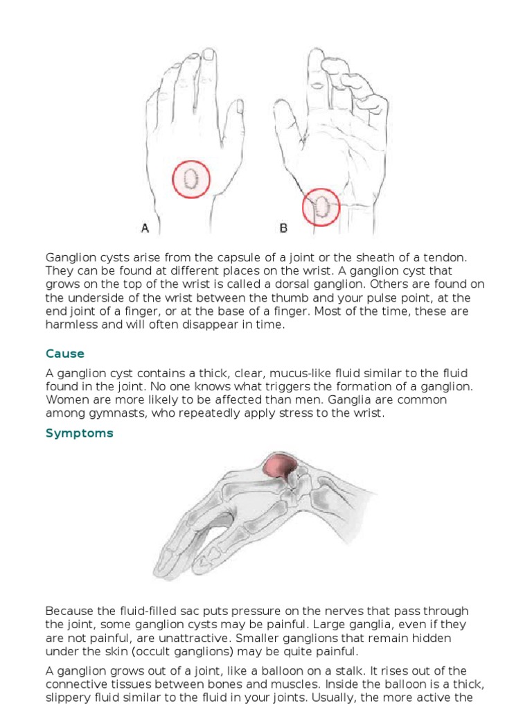 Ganglion Cysts | PDF | Musculoskeletal System | Medicine
