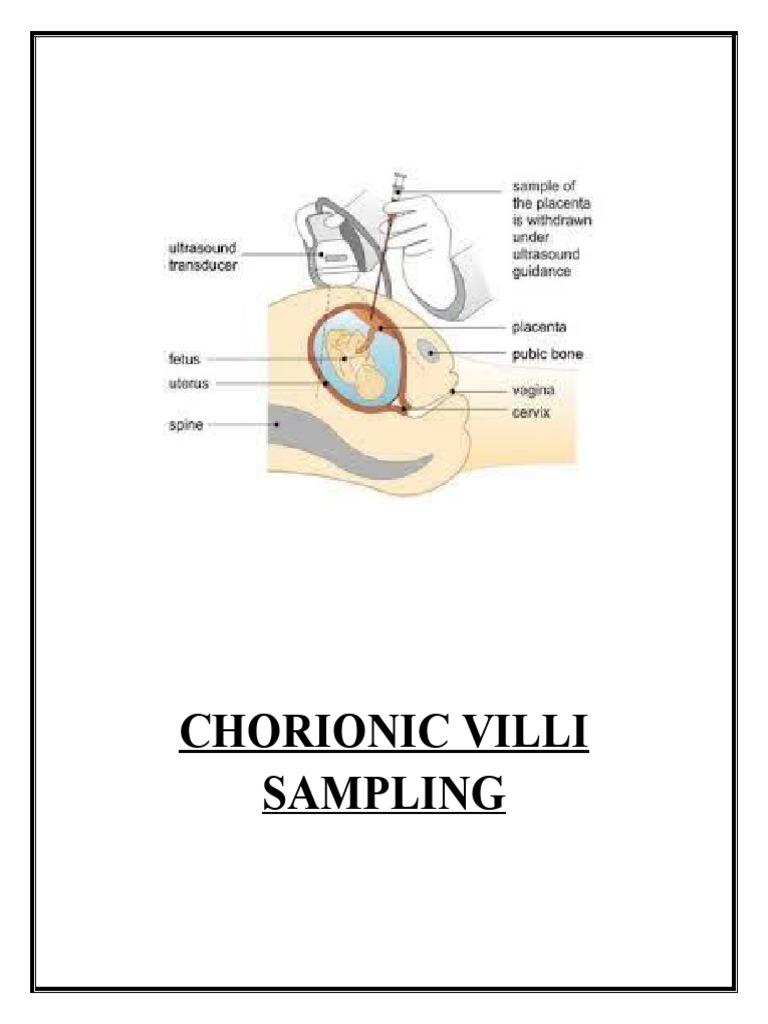 Chorionic Villi Sampling | PDF | Miscarriage | Medical Specialties