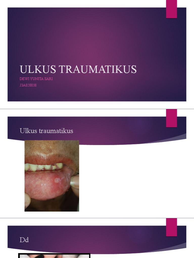 Ulkus Traumatikus | PDF