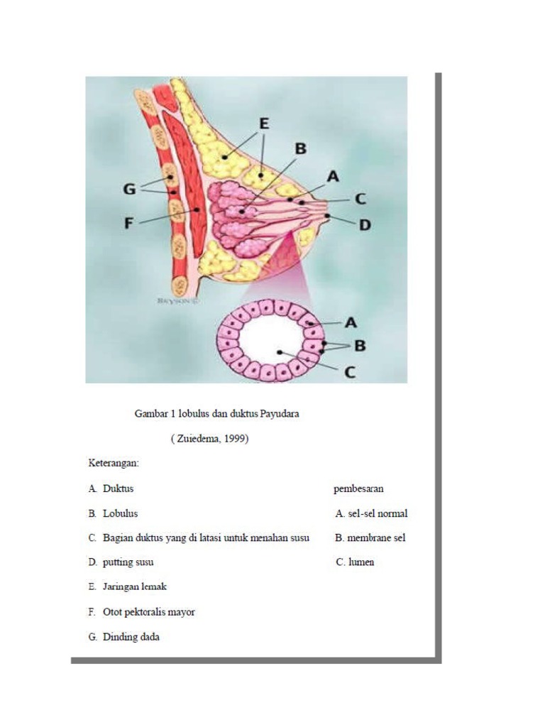 Kanker Payudara: In Situ vs Invasive | PDF