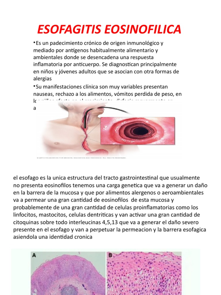 Esofagitis Eosinofilica-1 | PDF | Medicina | Medicina CLINICA