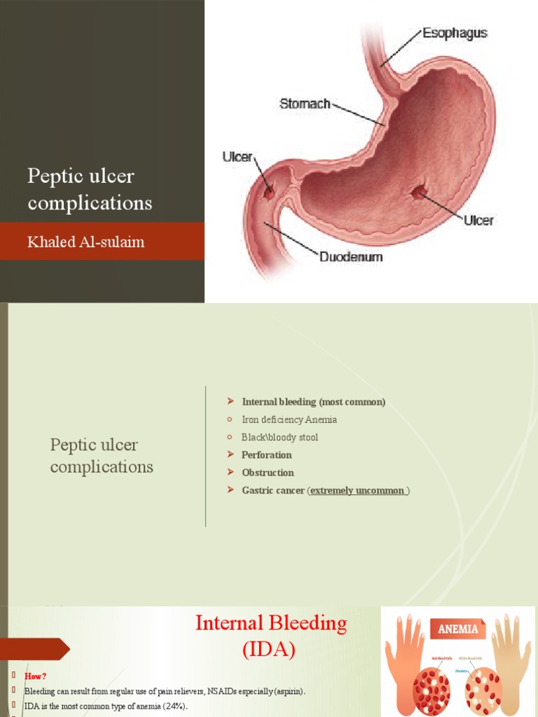 Peptic Ulcer Complications | PDF | Medicine | Health Sciences